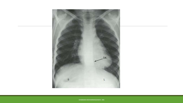 Segmental approach in congenital heart disease [autosaved].pptx 2.pptx ...