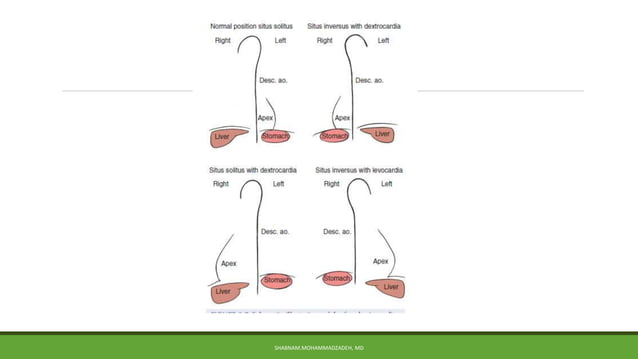 Segmental approach in congenital heart disease [autosaved].pptx 2.pptx ...