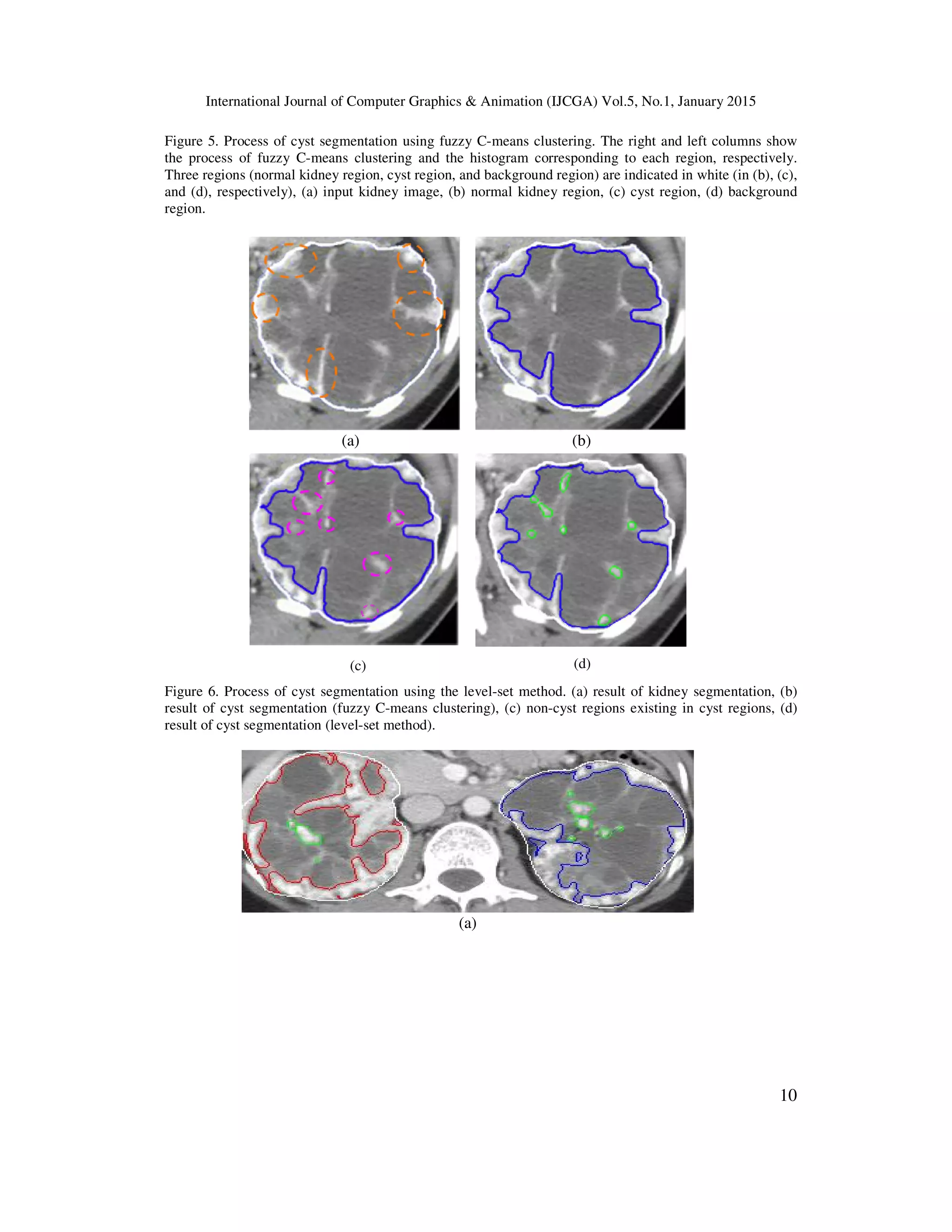 Segmentation of cysts in kidney and 3 d volume calculation from ct ...