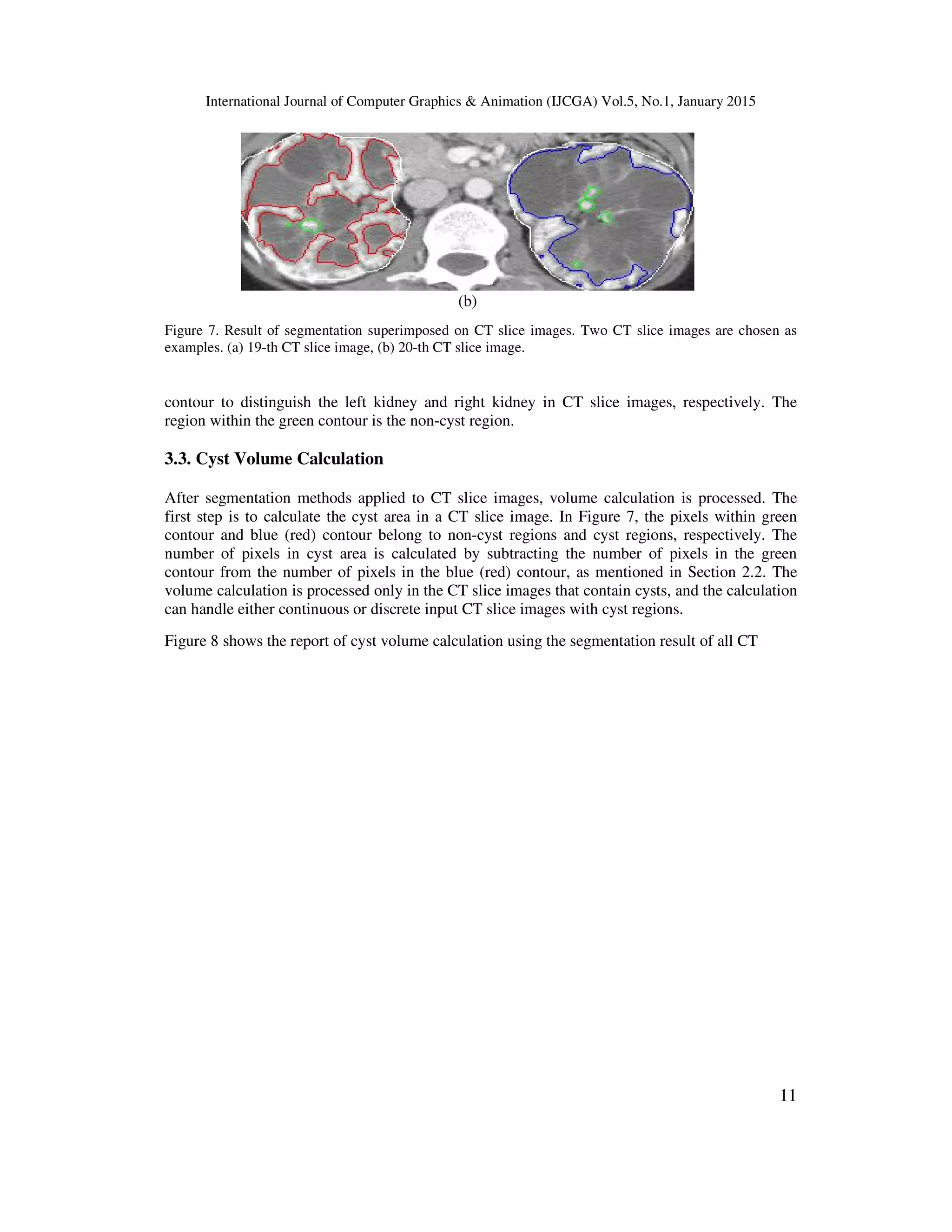 Segmentation of cysts in kidney and 3 d volume calculation from ct ...