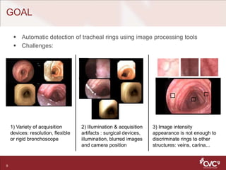 Segmentation of Tracheal Rings in Videobronchoscopy | PPT