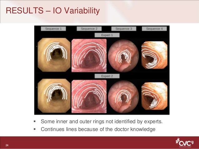 Segmentation of Tracheal Rings in Videobronchoscopy