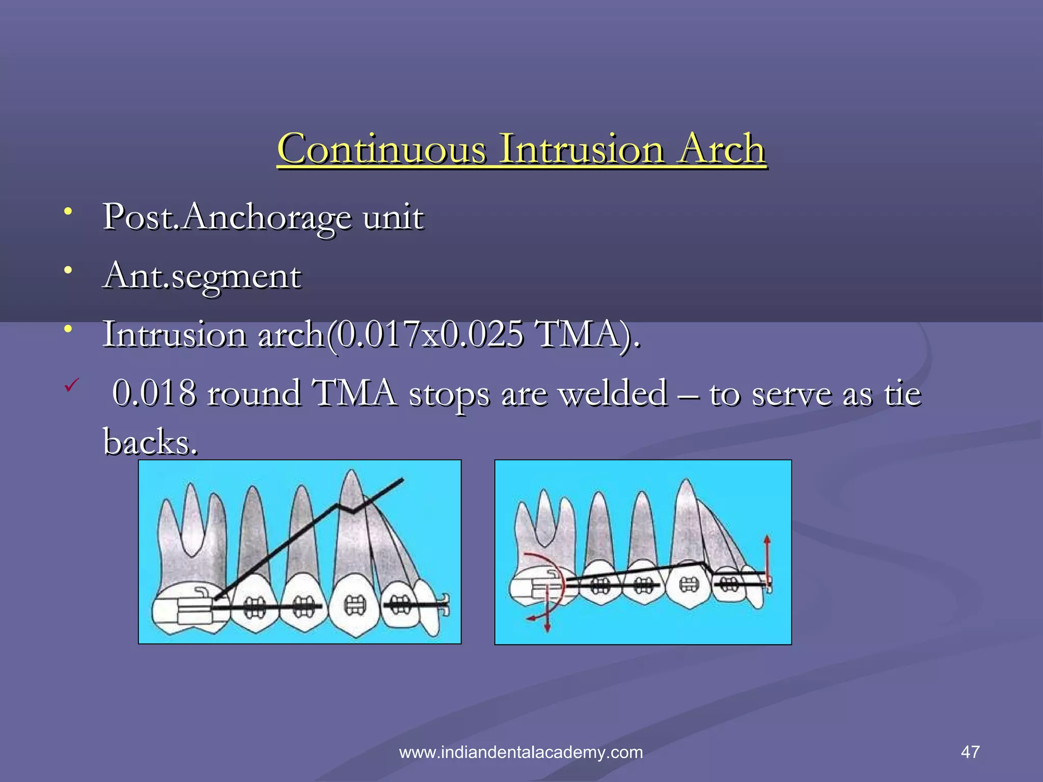 Segmented arch technique /certified fixed orthodontic courses by Indian ...