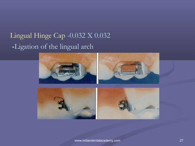 Segmented arch technique /certified fixed orthodontic courses by Indian ...