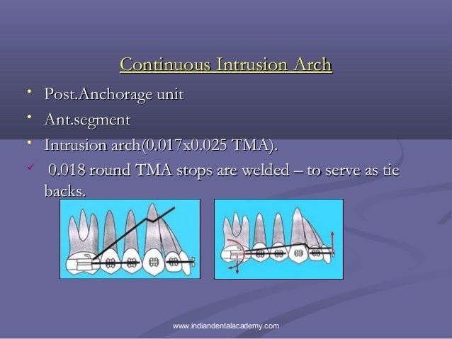 Segmented arch technique