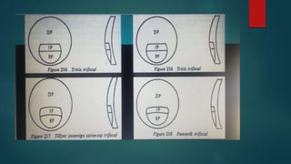 Segmented Multifocal Lenses.pptx
