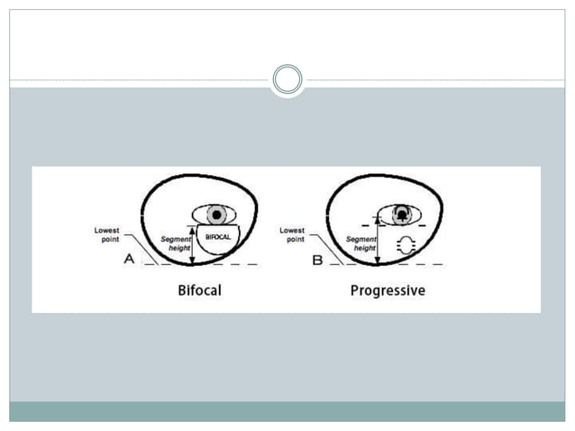 Segment height | PPTX | Eye and Vision Conditions | Diseases and Conditions