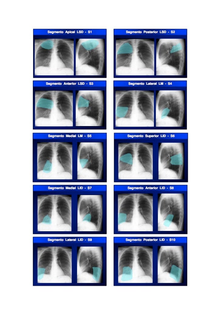 Segmentos do Pulmão Direito ao RX
