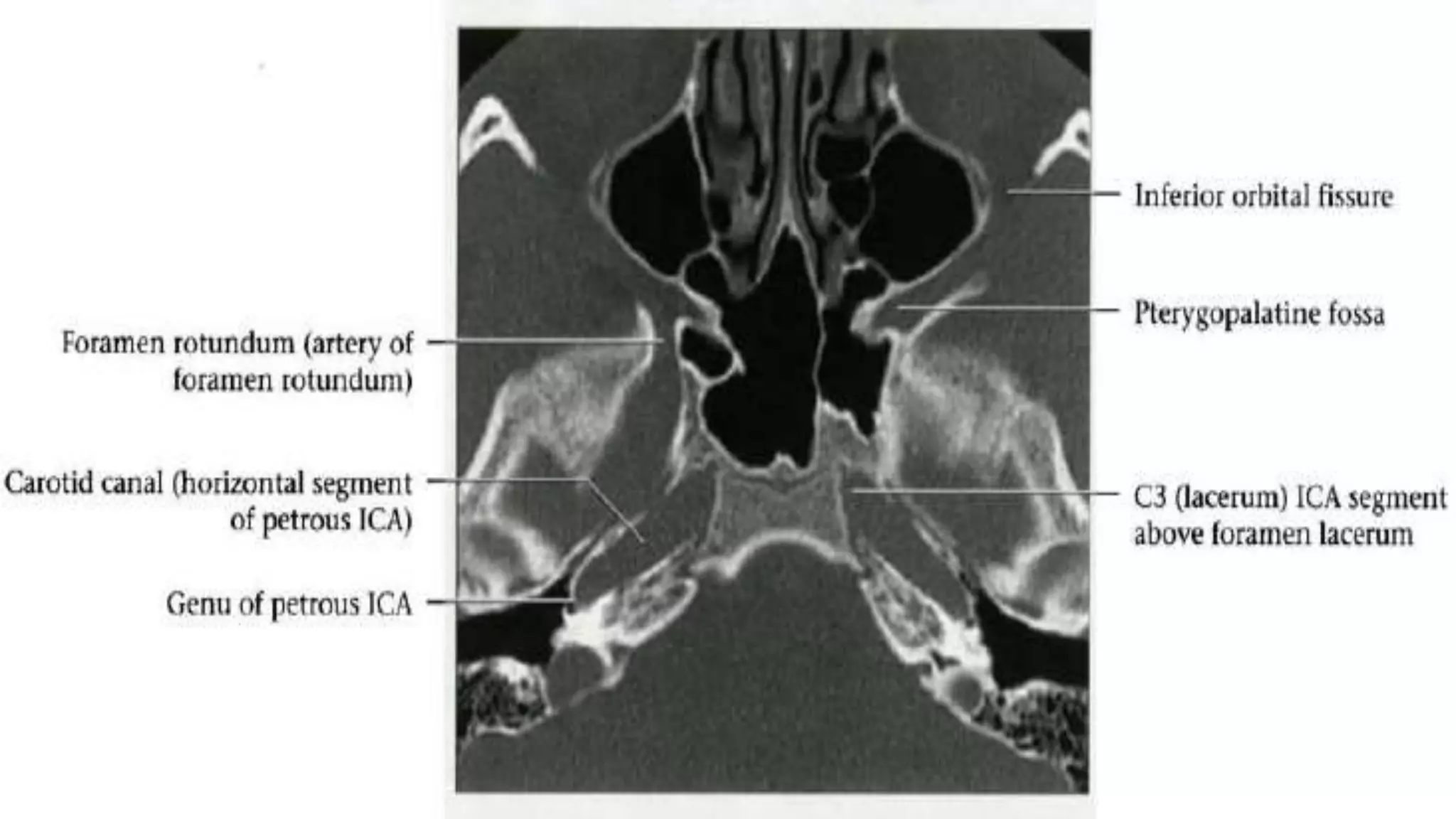 Segments of internal carotid artery | PPTX