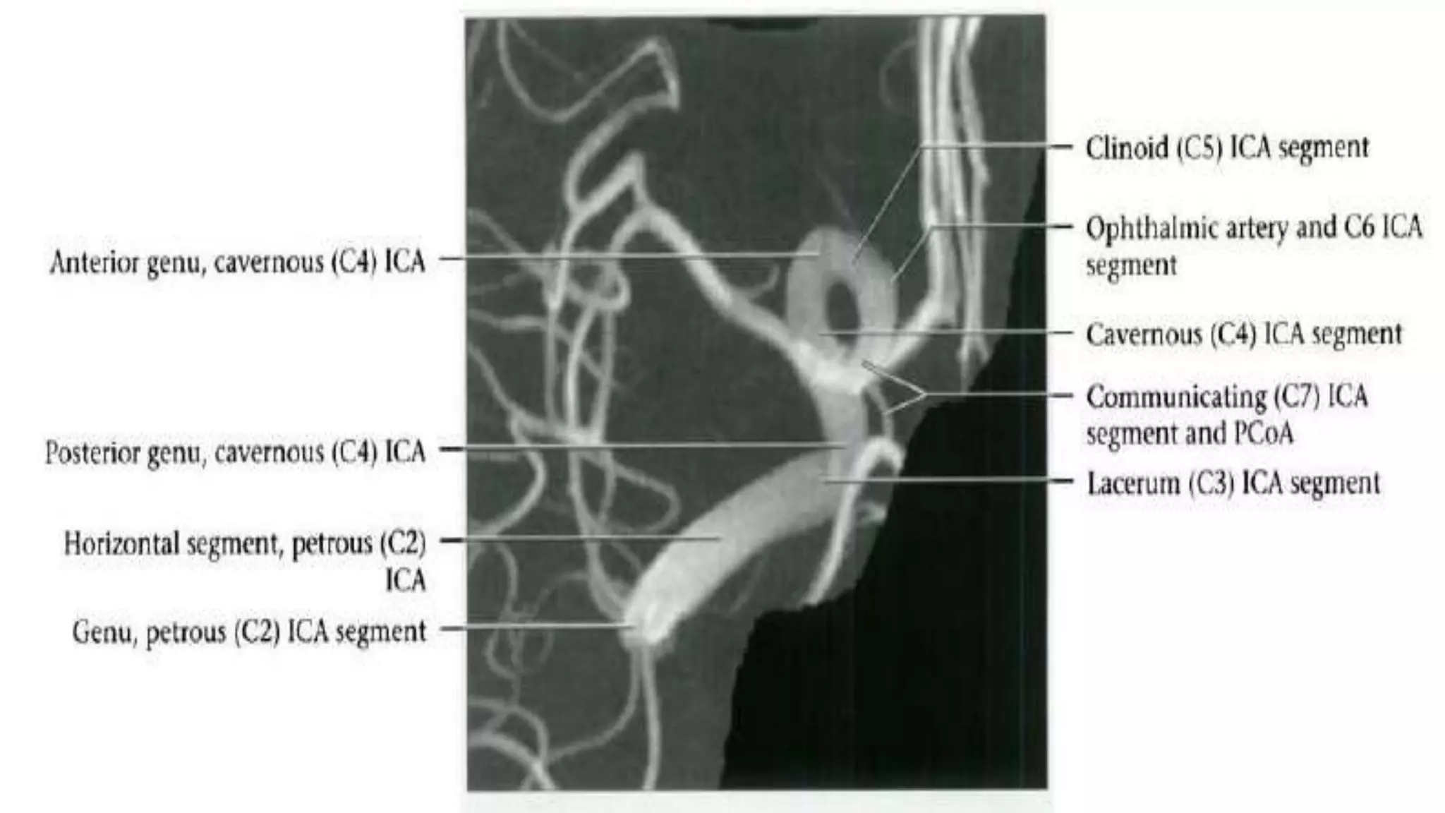 Segments of internal carotid artery | PPTX