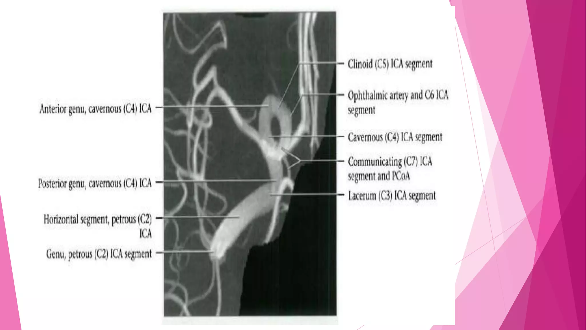 Segments of internal carotid artery | PPTX