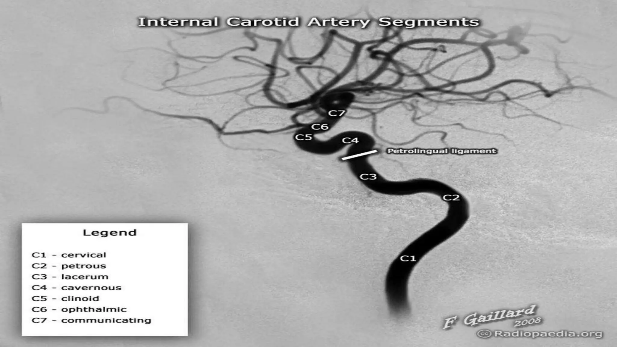 Segments of internal carotid artery | PPTX