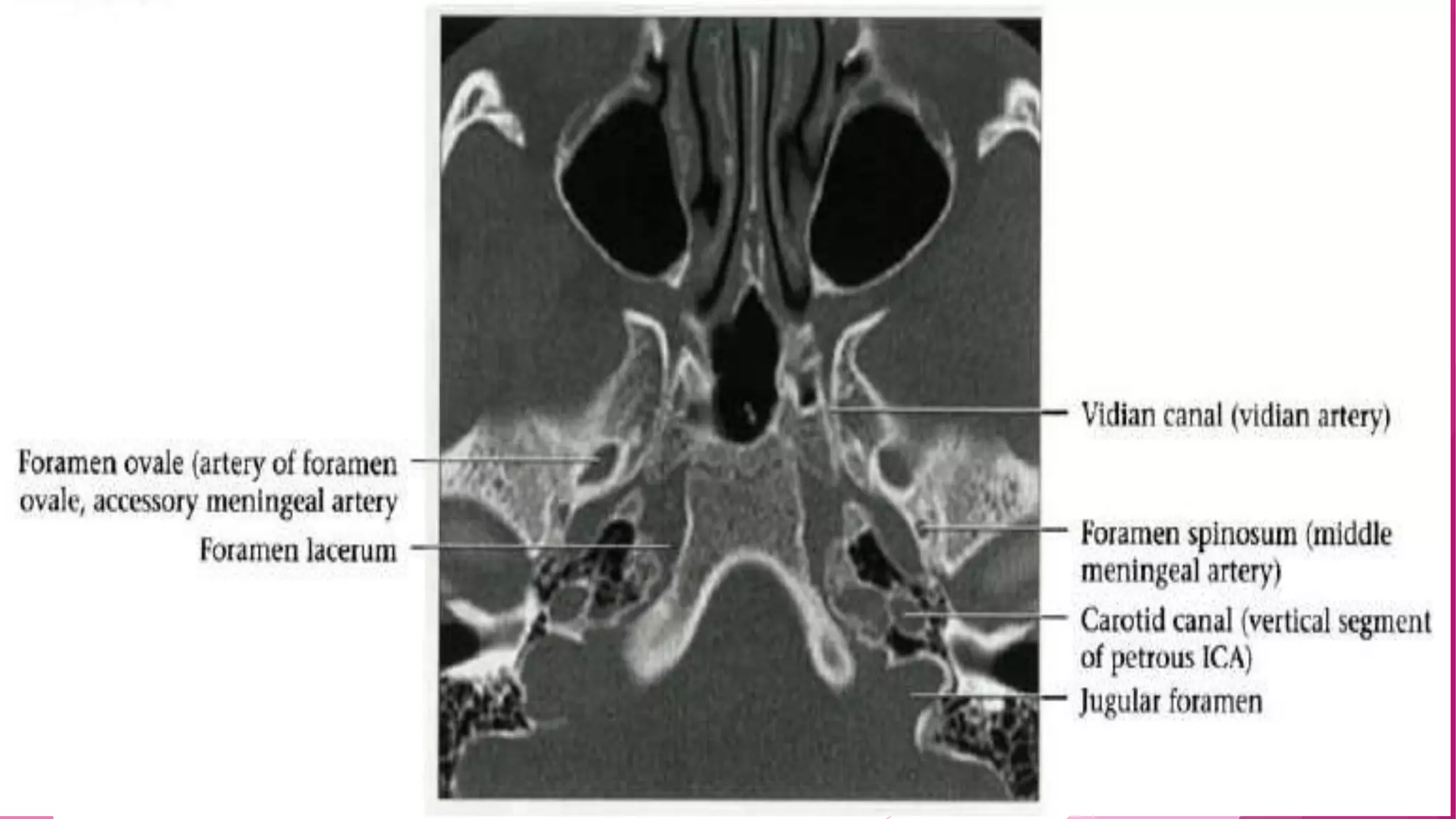 Segments of internal carotid artery | PPTX