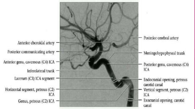 Segments of internal carotid artery | PPTX | Ear, Nose and Throat ...