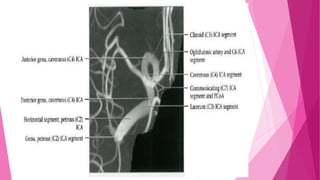 Segments of internal carotid artery | PPTX