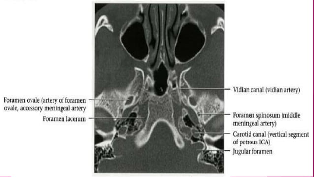 Segments of internal carotid artery | PPTX | Ear, Nose and Throat ...