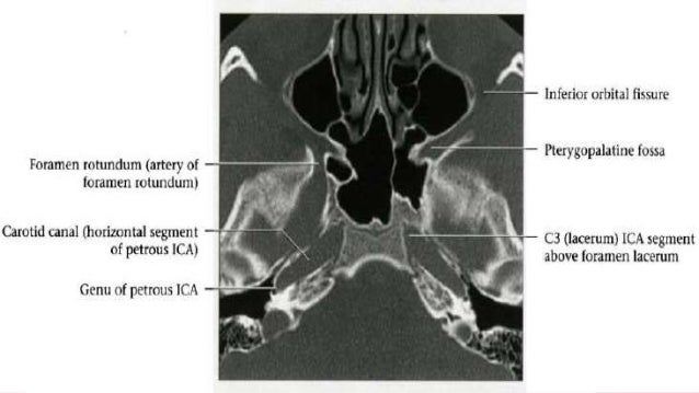 Segments of internal carotid artery