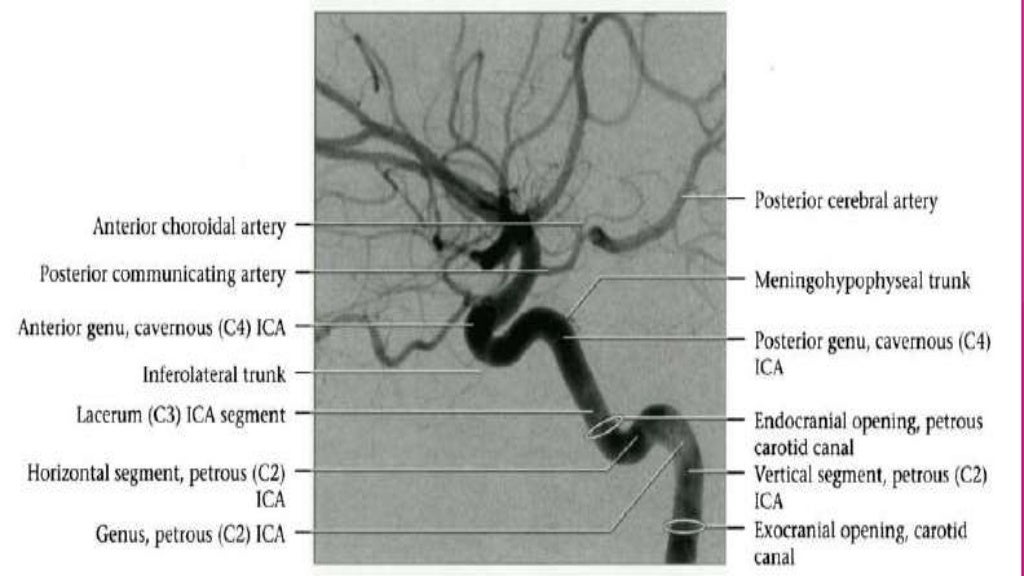Internal Carotid Artery