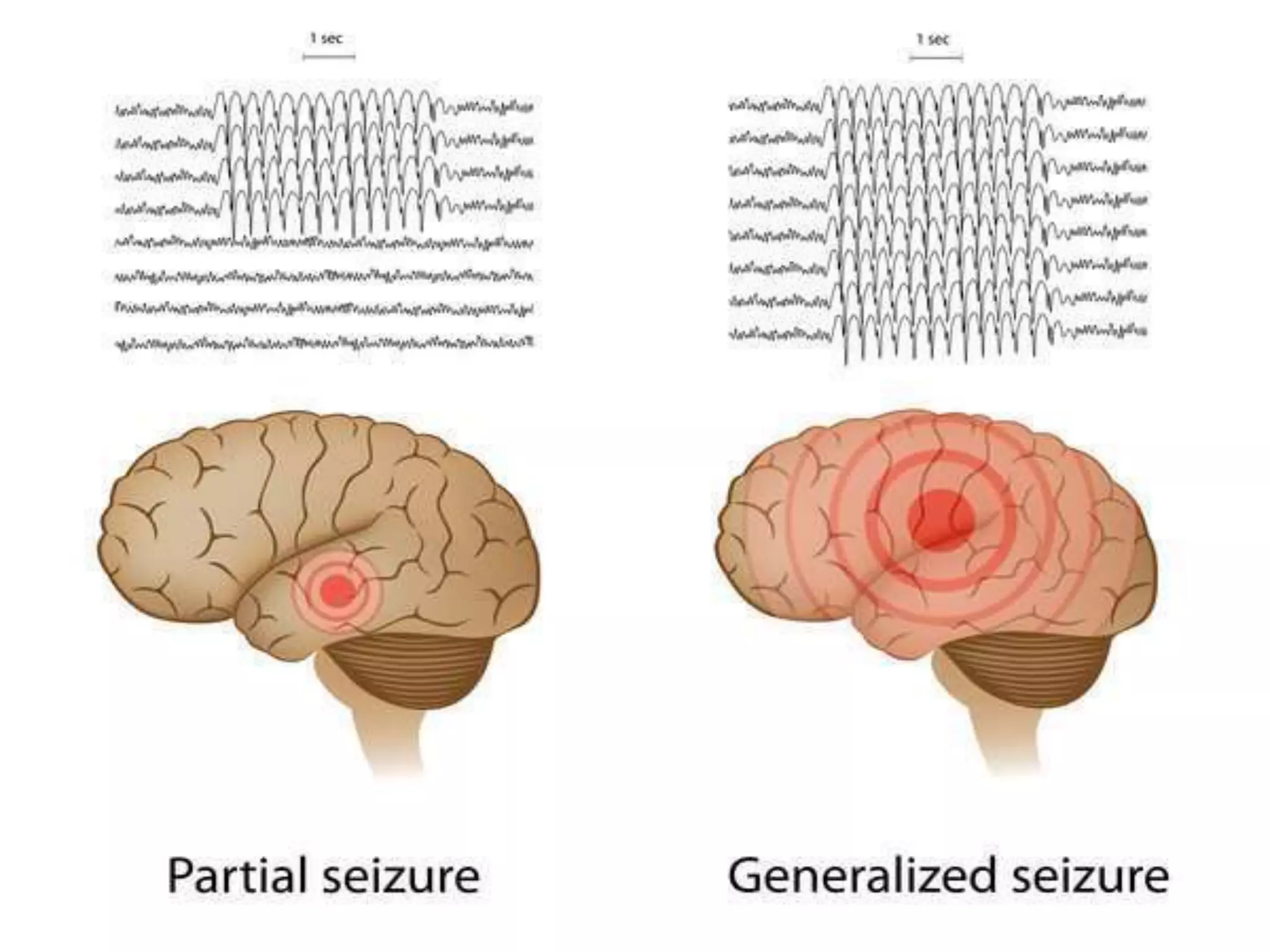 Seizure | PPTX