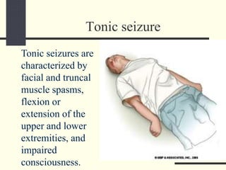 Tonic Seizure