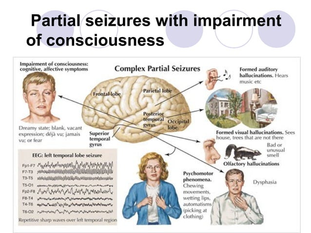 Seizures disorder | PPT