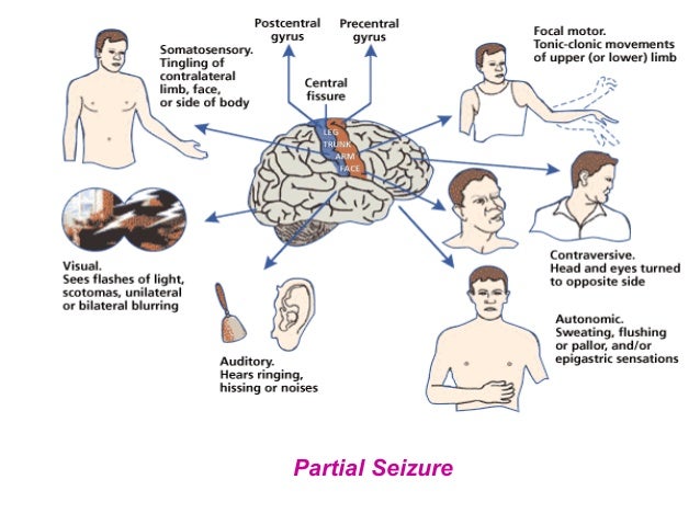 Seizures disorder