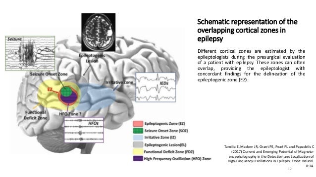 Seizure Semiology: Introduction
