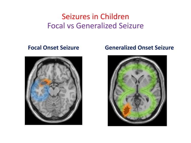 Seizures in children 2021 | PDF | Brain and Nervous System Disorders ...