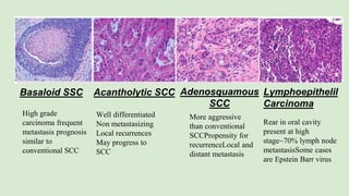(Oral Squamous Cel Carcinoma).pptx