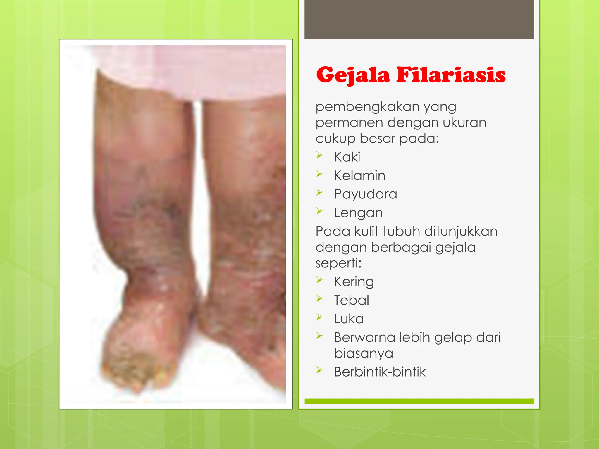 SEKILAS TENTANG PENYAKIT FILARIASIS PPT.pptx