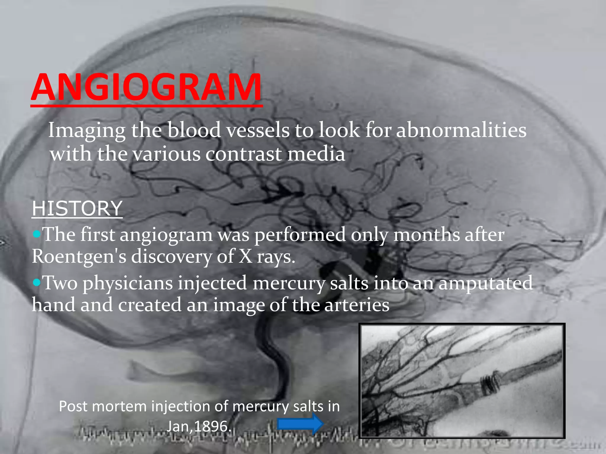 SELDINGER TECHNIQUE & INTERVENTIONAL RADIOLOGY | PPTX