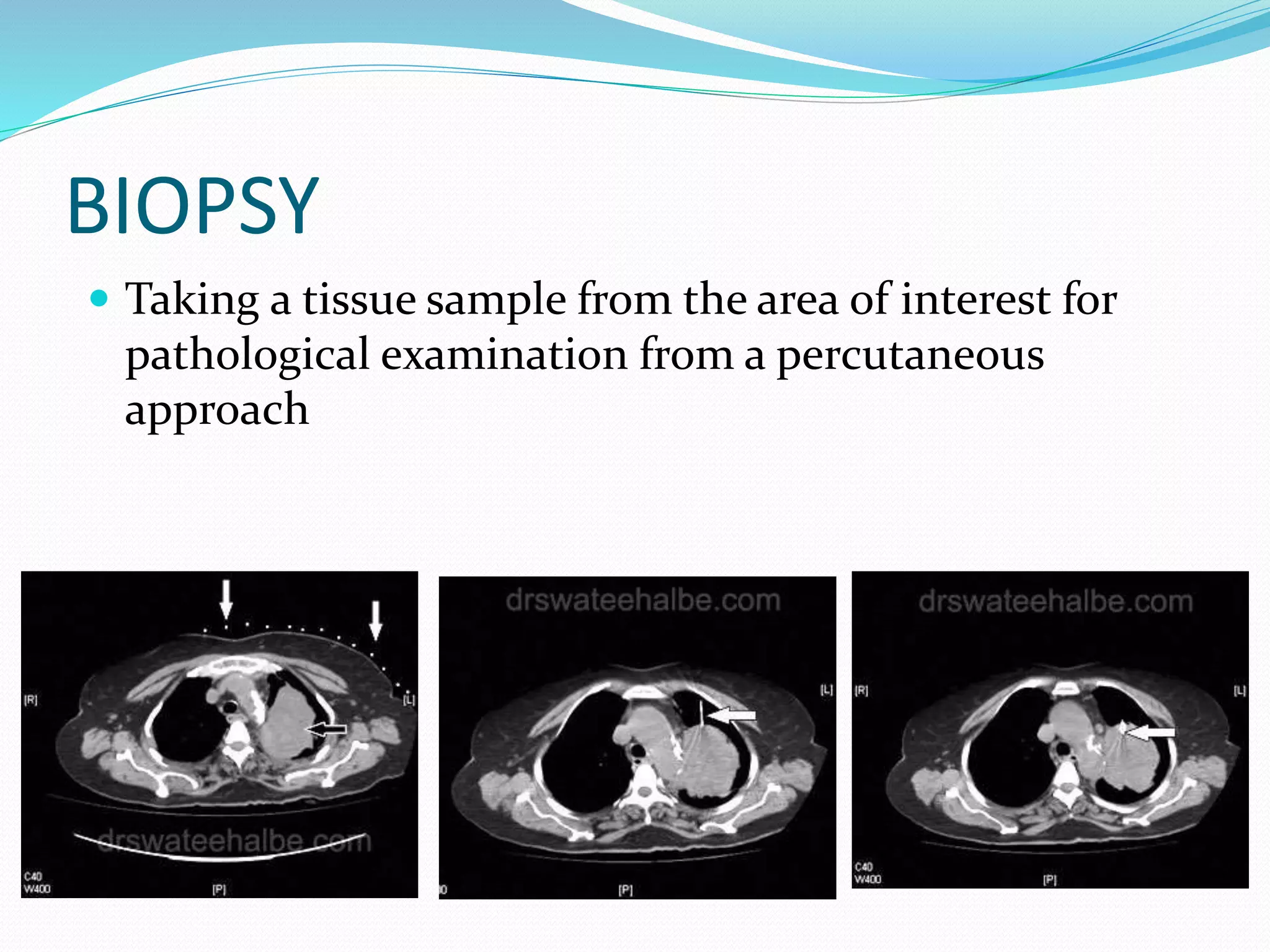 SELDINGER TECHNIQUE & INTERVENTIONAL RADIOLOGY | PPTX