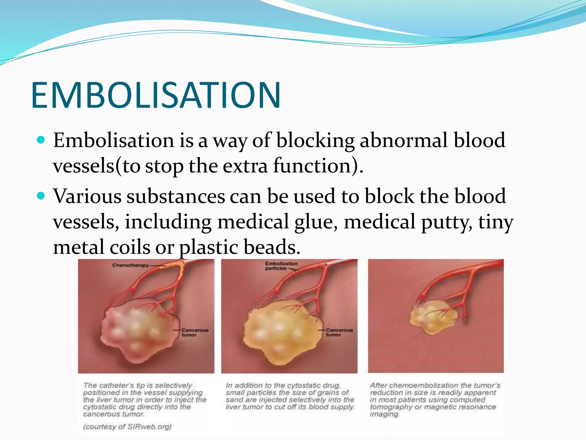 SELDINGER TECHNIQUE & INTERVENTIONAL RADIOLOGY | PPTX