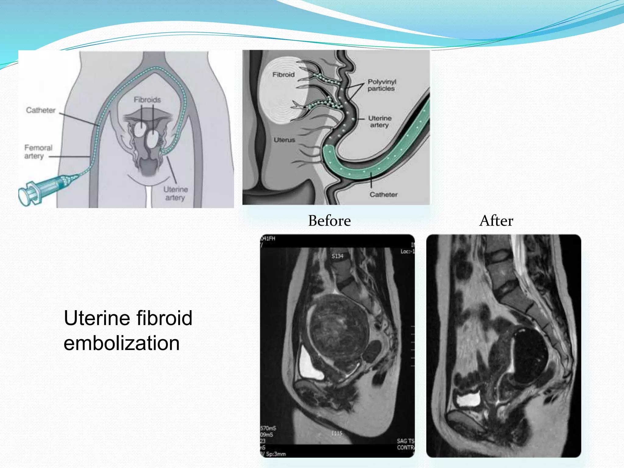 SELDINGER TECHNIQUE & INTERVENTIONAL RADIOLOGY | PPTX