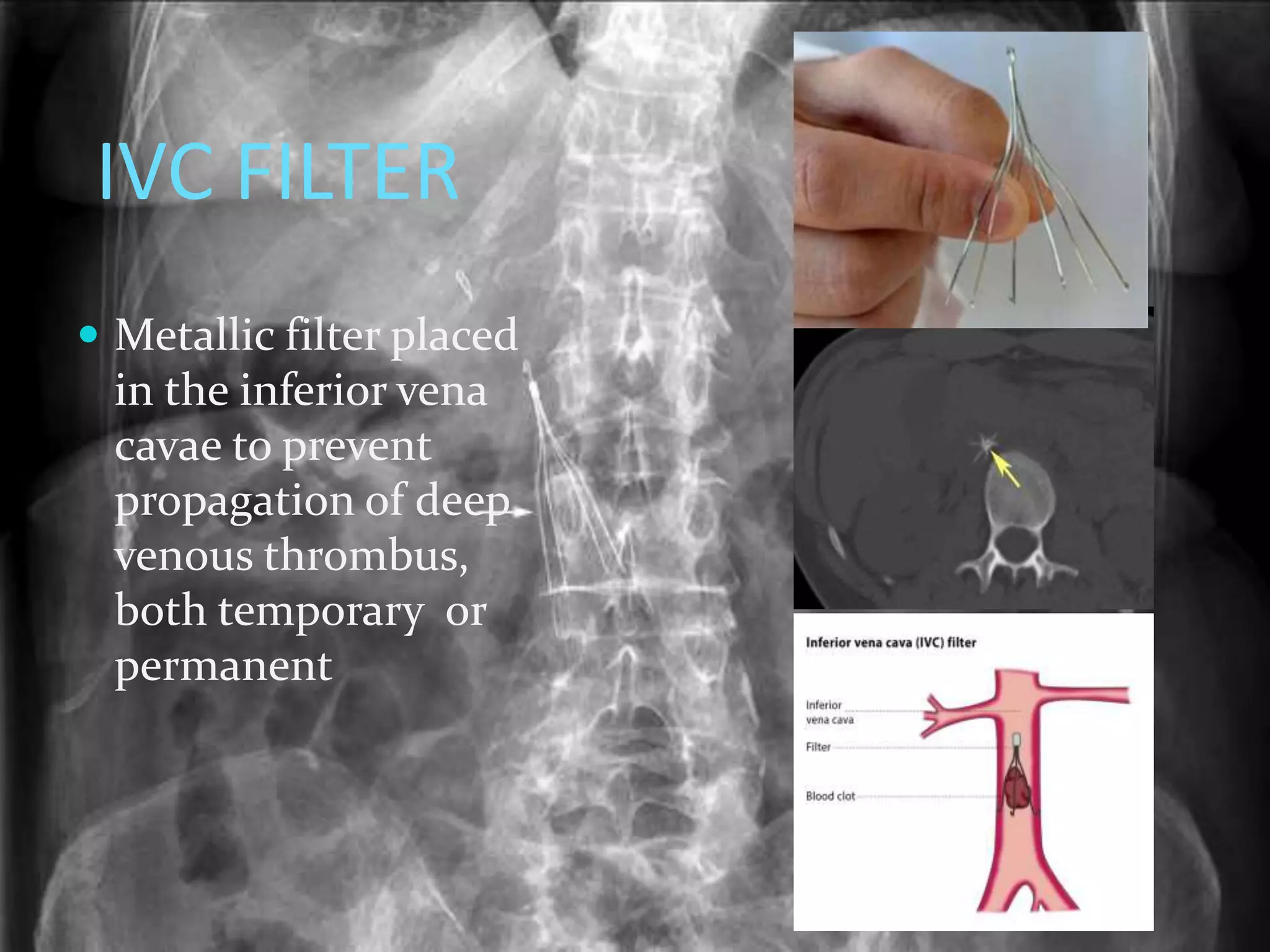 SELDINGER TECHNIQUE & INTERVENTIONAL RADIOLOGY | PPTX