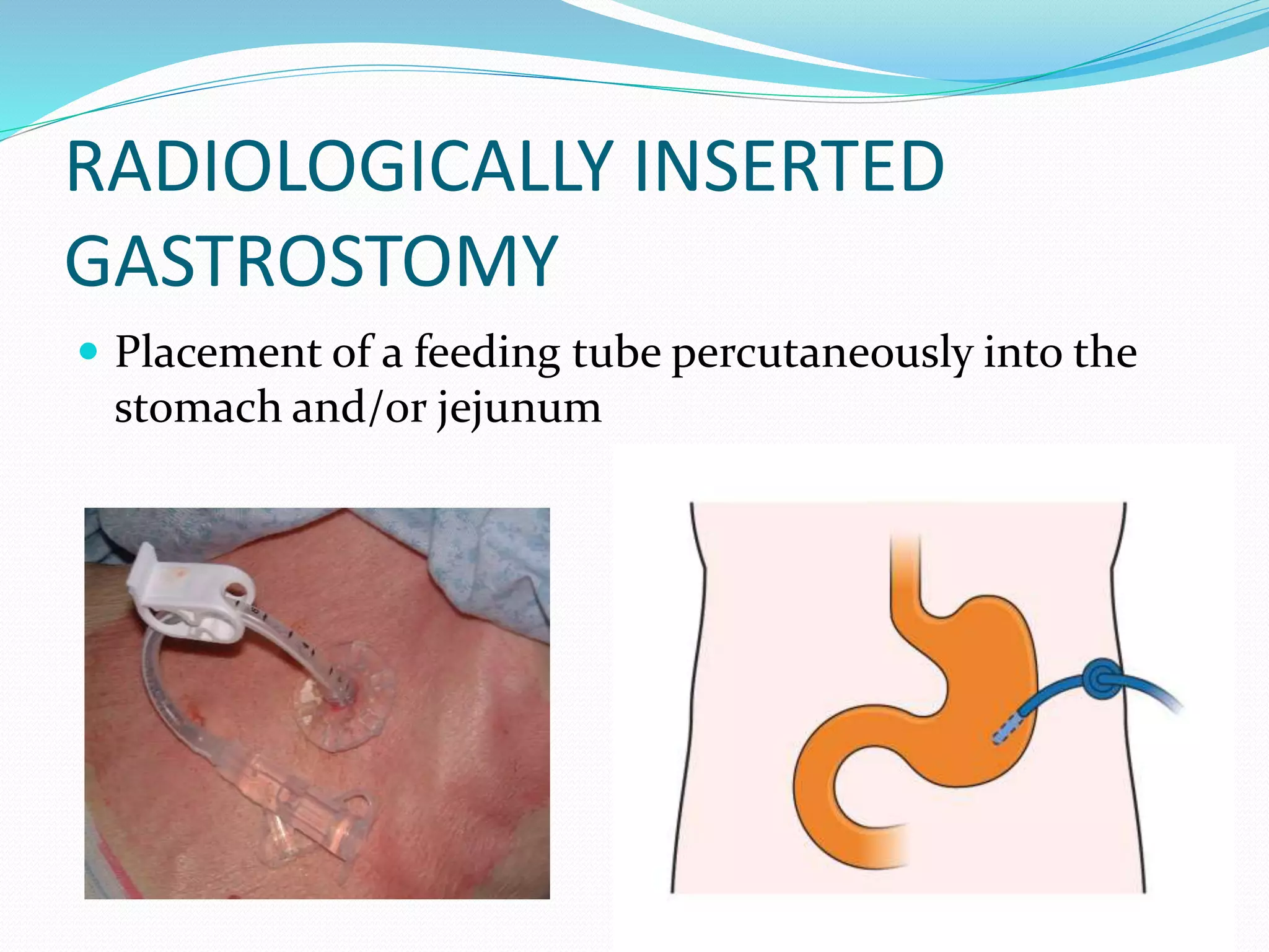 SELDINGER TECHNIQUE & INTERVENTIONAL RADIOLOGY | PPTX