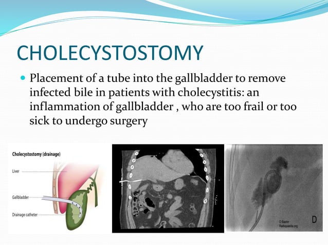 SELDINGER TECHNIQUE & INTERVENTIONAL RADIOLOGY | PPTX | First Aid ...