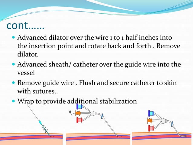 SELDINGER TECHNIQUE & INTERVENTIONAL RADIOLOGY | PPTX | First Aid ...