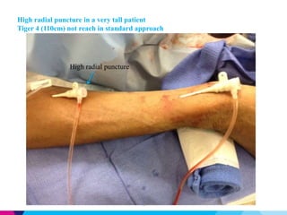 Kwan TW - AIMRADIAL 2014 Technical - Selection of catheters | PPT