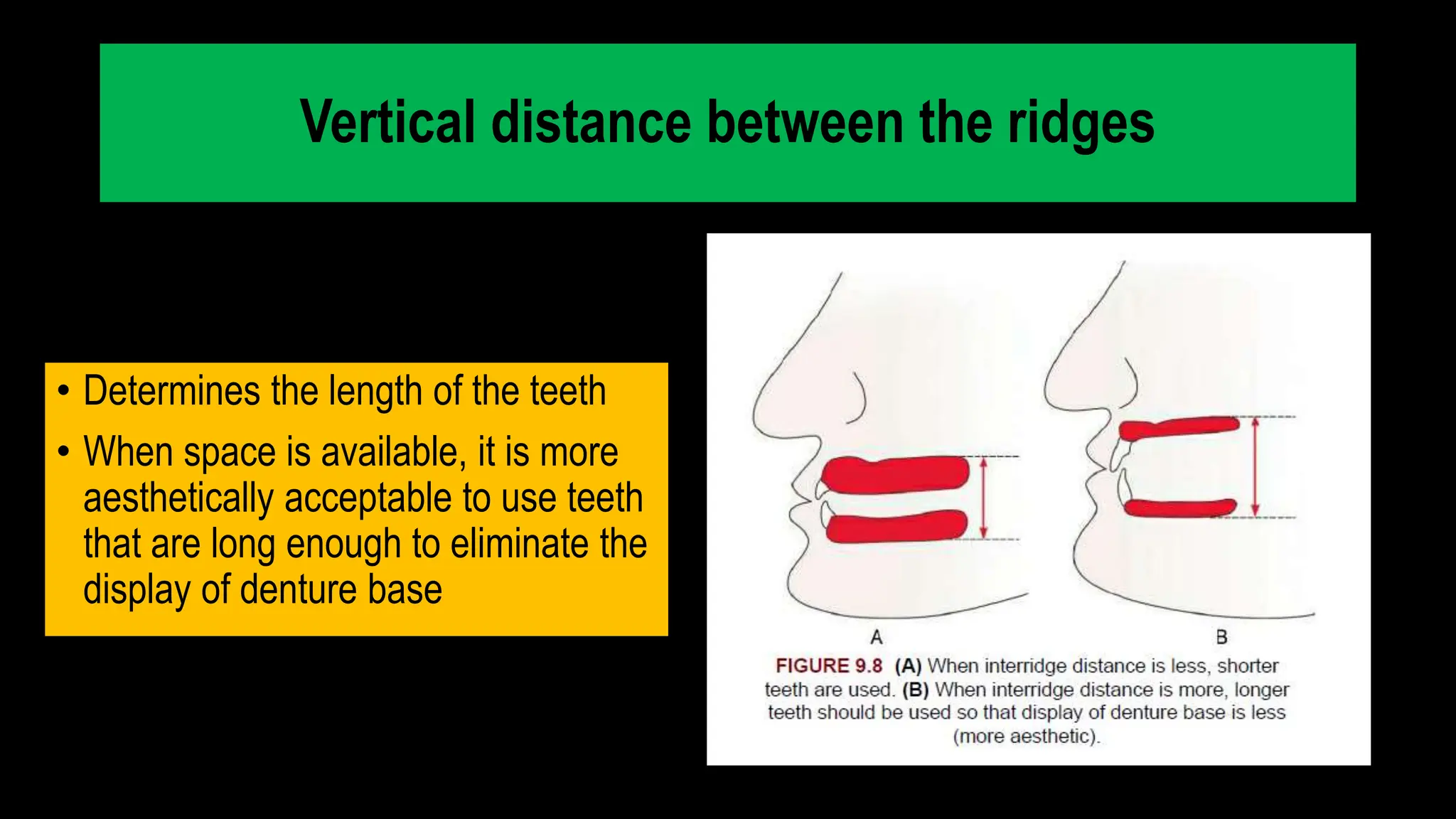 SELECTION OF ANTERIOR TEETh in complete denture | PPTX
