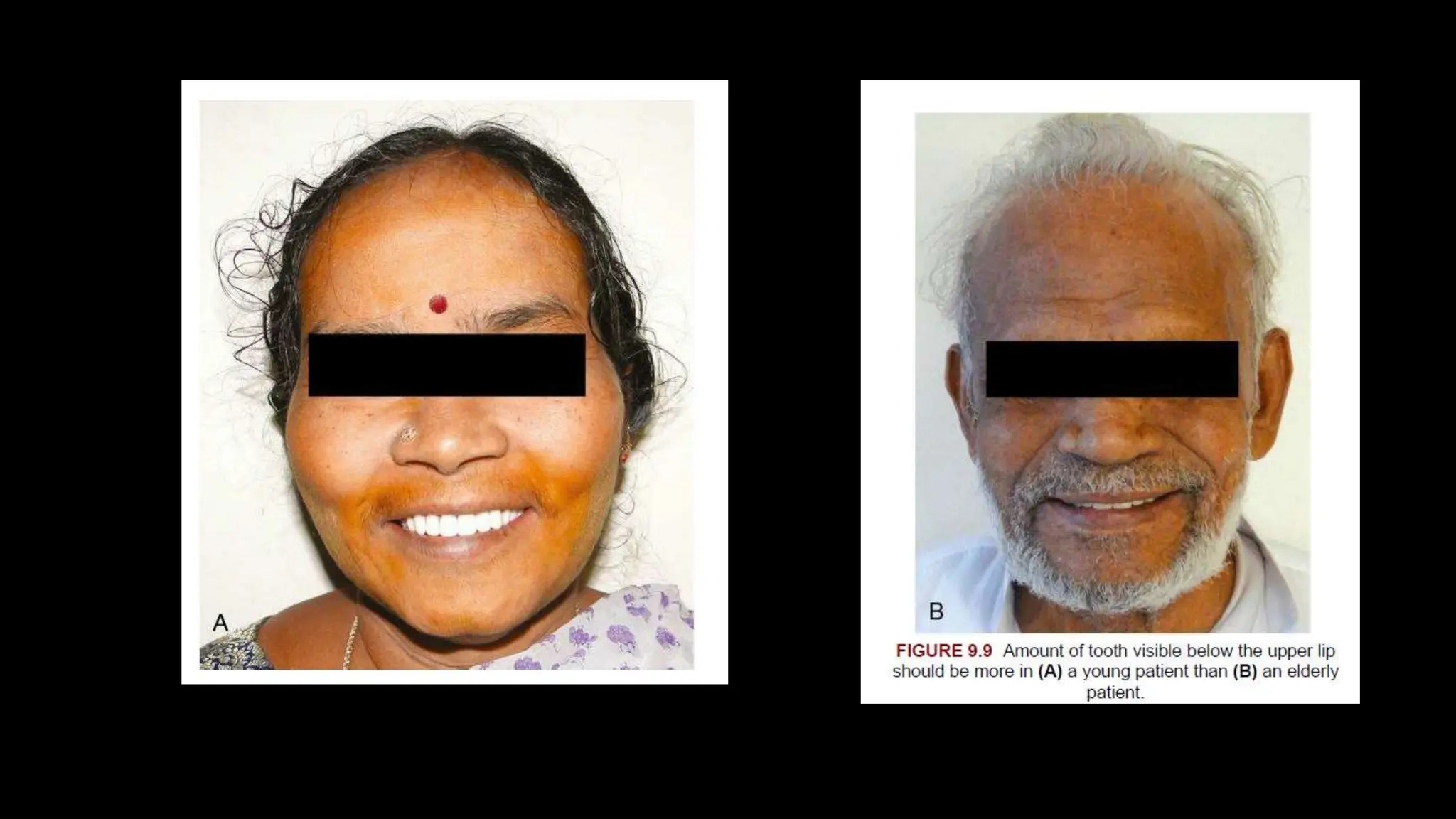 SELECTION OF ANTERIOR TEETh in complete denture | PPTX