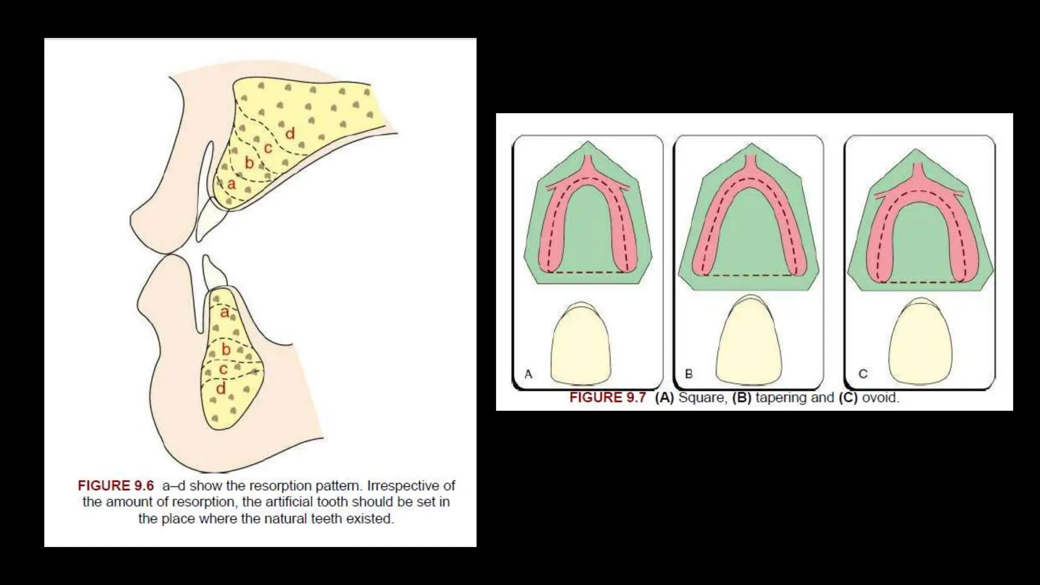 SELECTION OF ANTERIOR TEETh in complete denture | PPTX