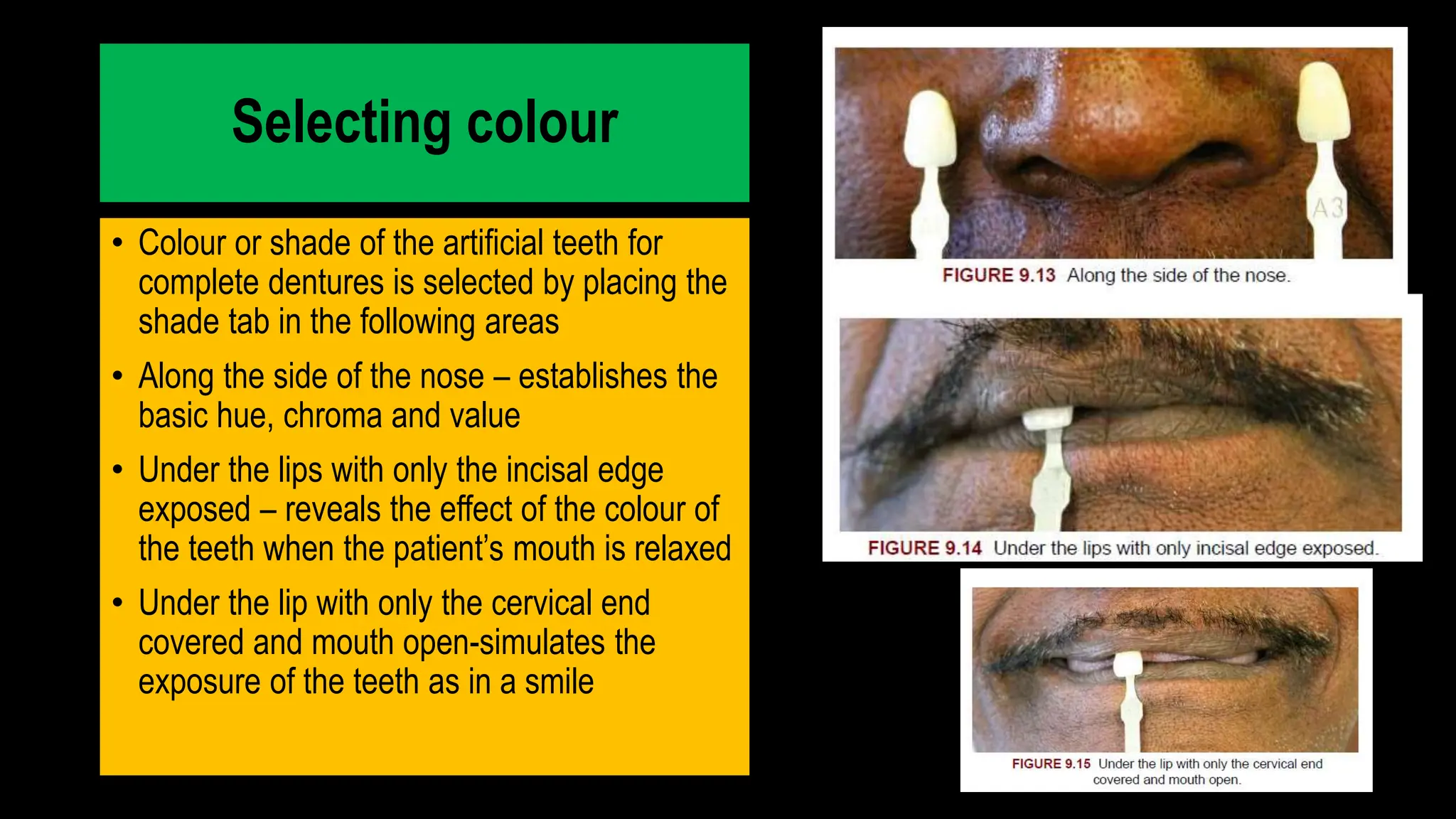 SELECTION OF ANTERIOR TEETh in complete denture | PPTX