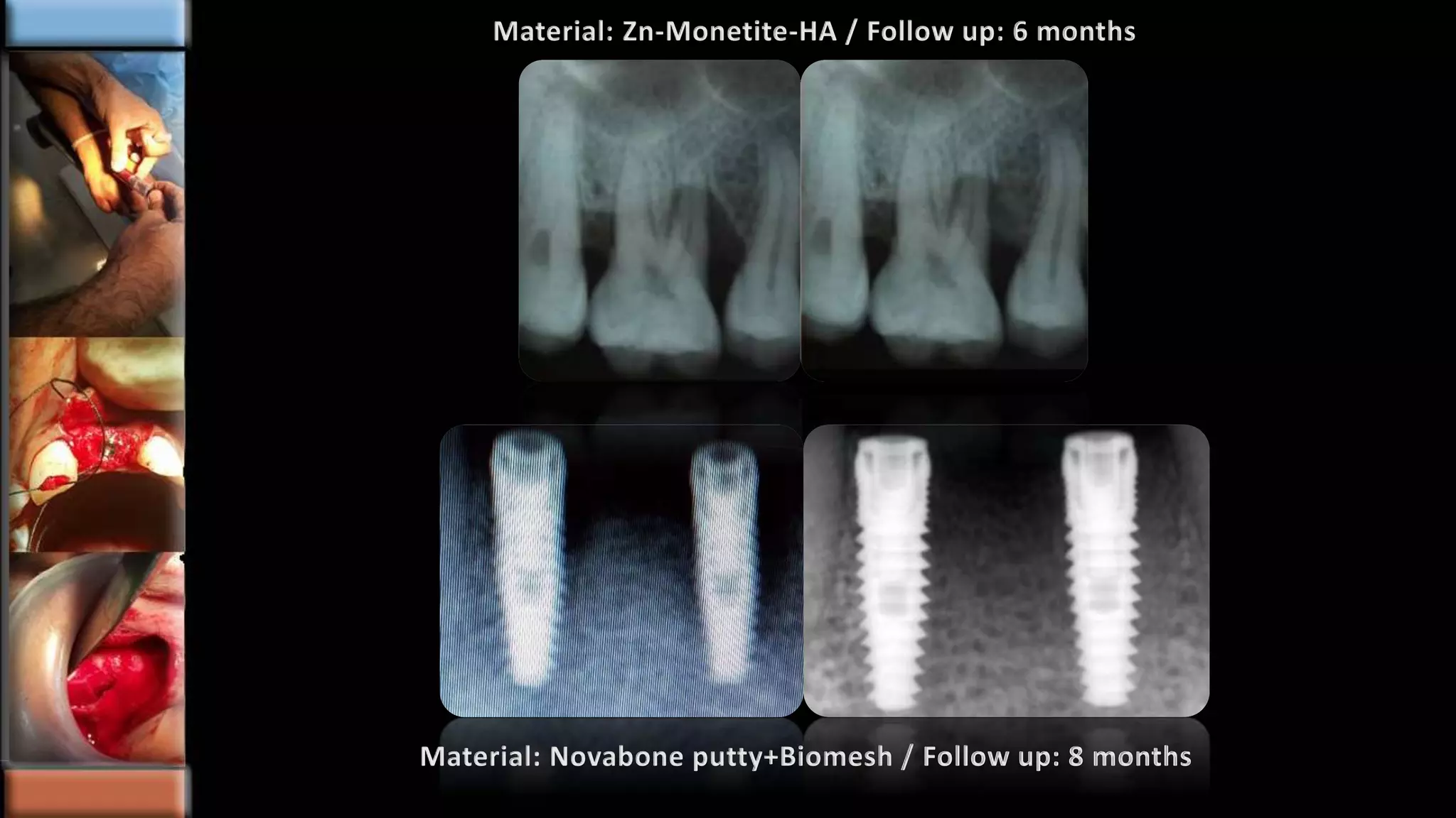 Selection of bone grafts in periodontics | PPTX | Dental Health ...