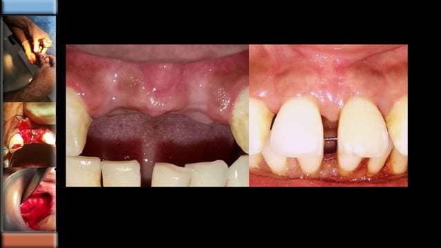 Selection of bone grafts in periodontics | PPTX | Dental Health ...