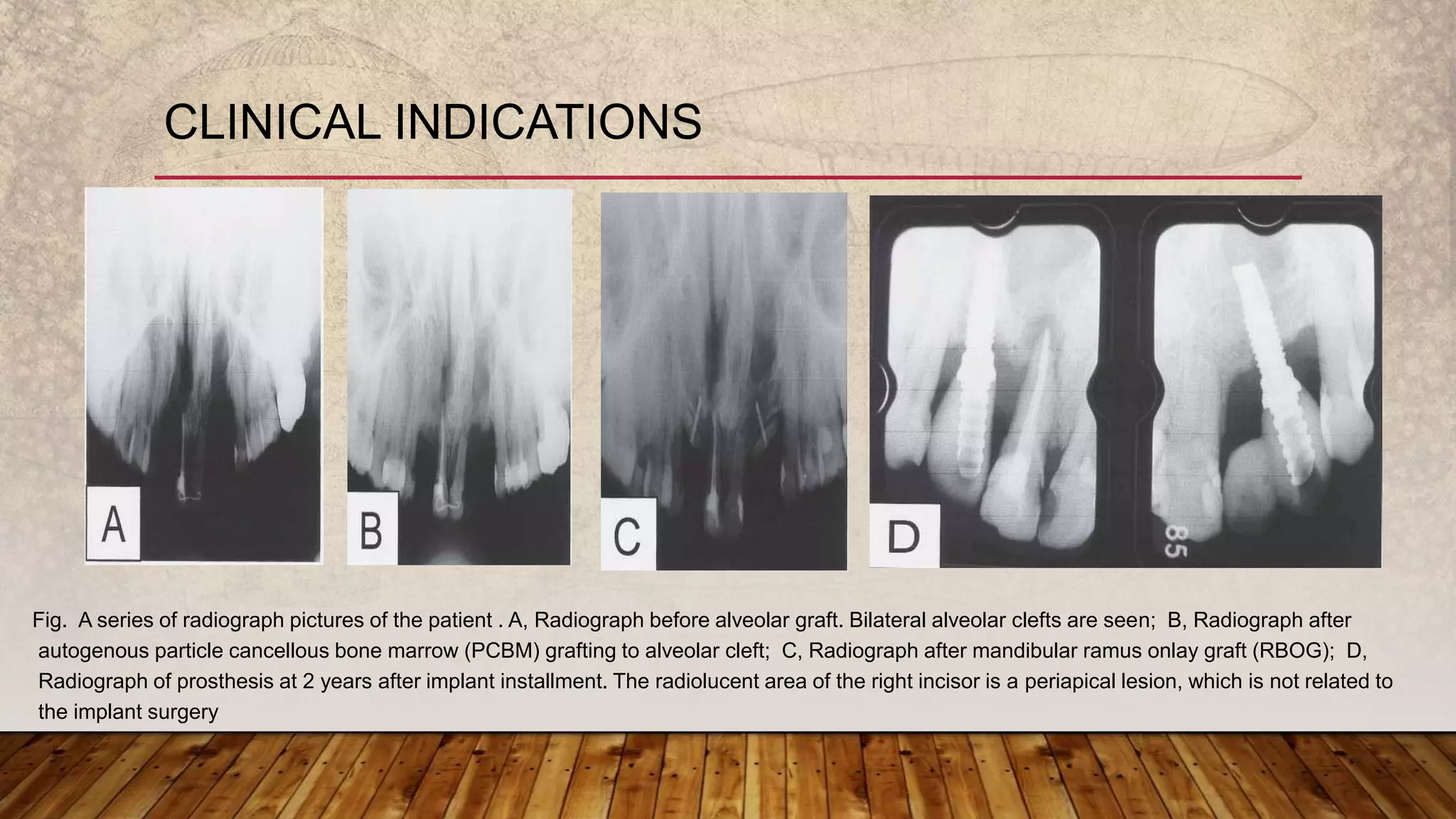 Selection of patient for dental implant | PPTX