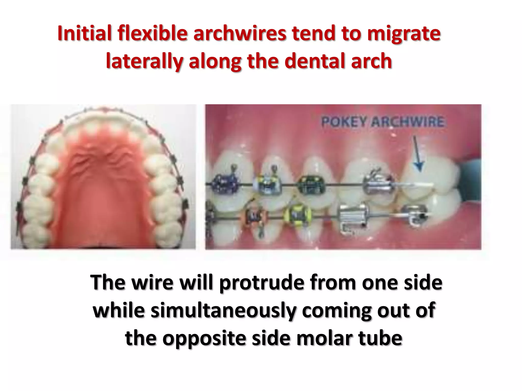 selection of preformed archwires during the alignment stage of ...