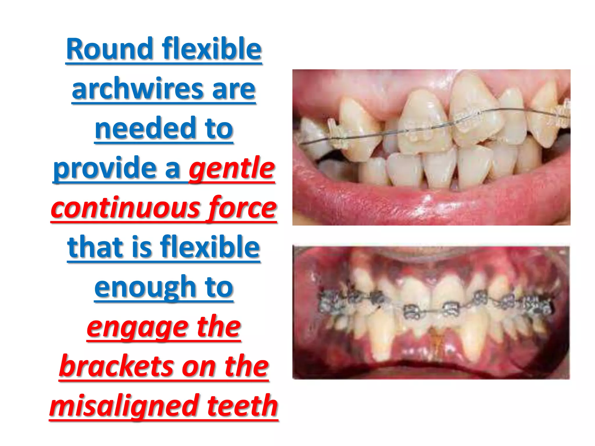 selection of preformed archwires during the alignment stage of ...