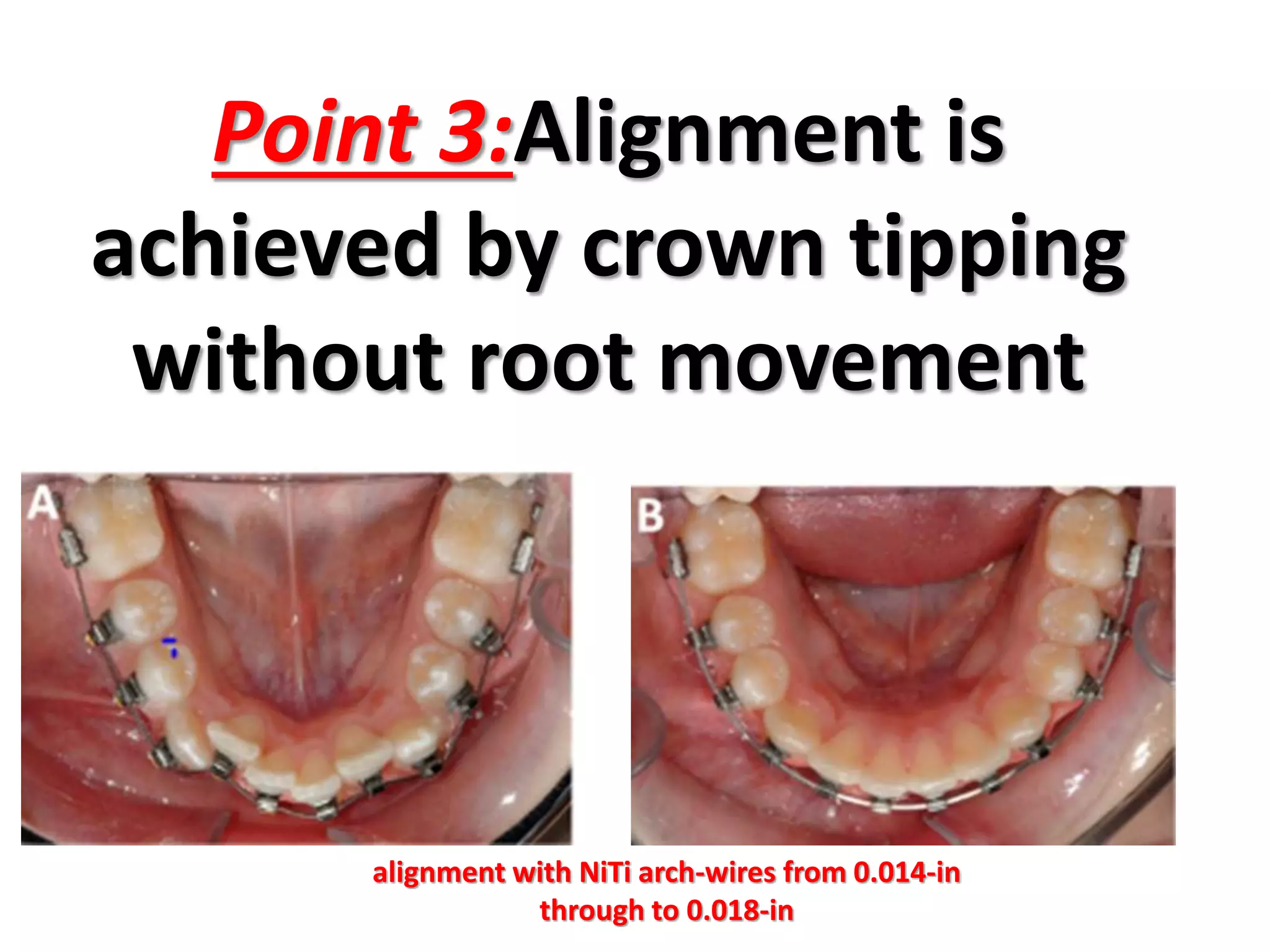 selection of preformed archwires during the alignment stage of ...
