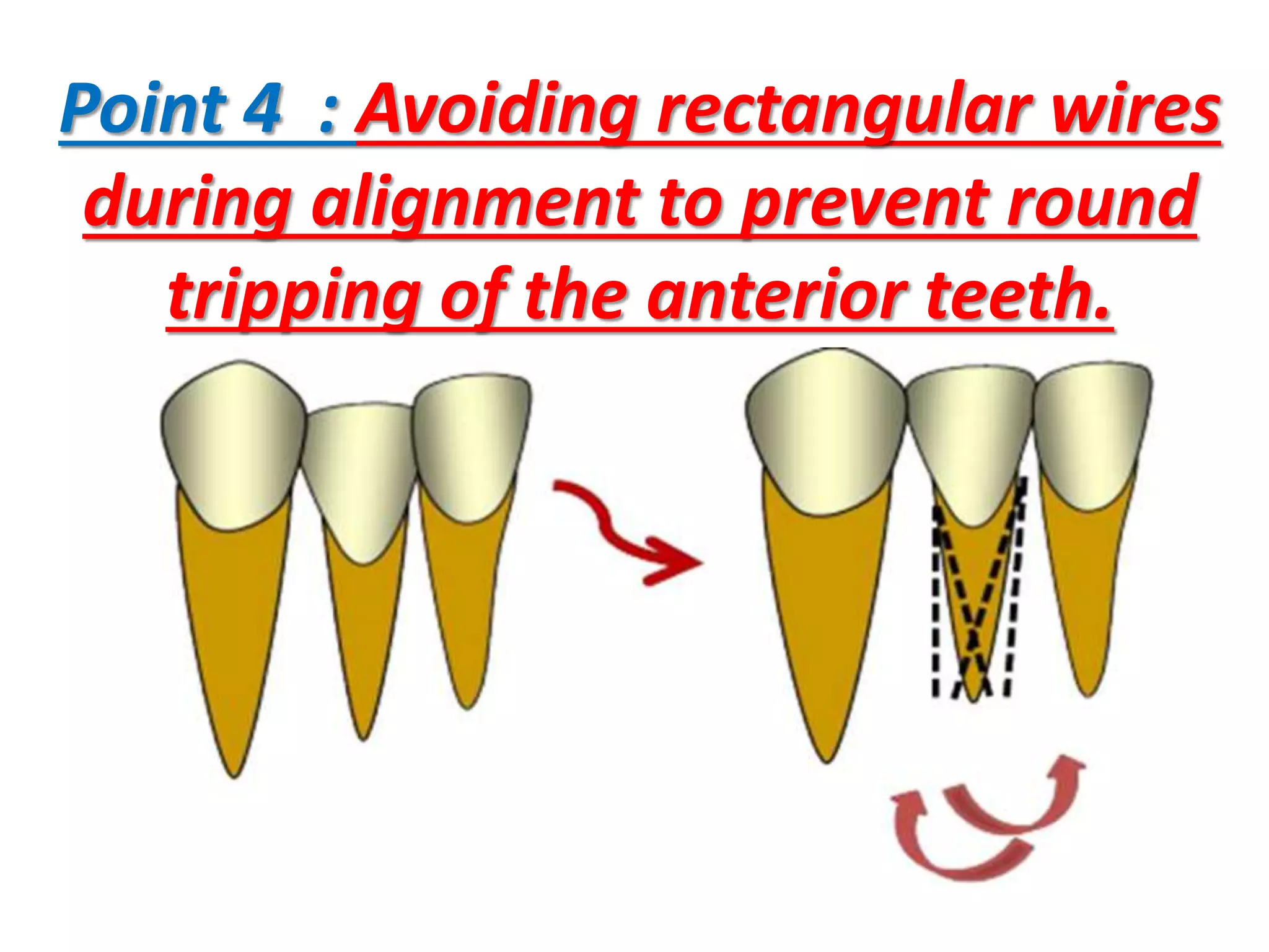 selection of preformed archwires during the alignment stage of ...
